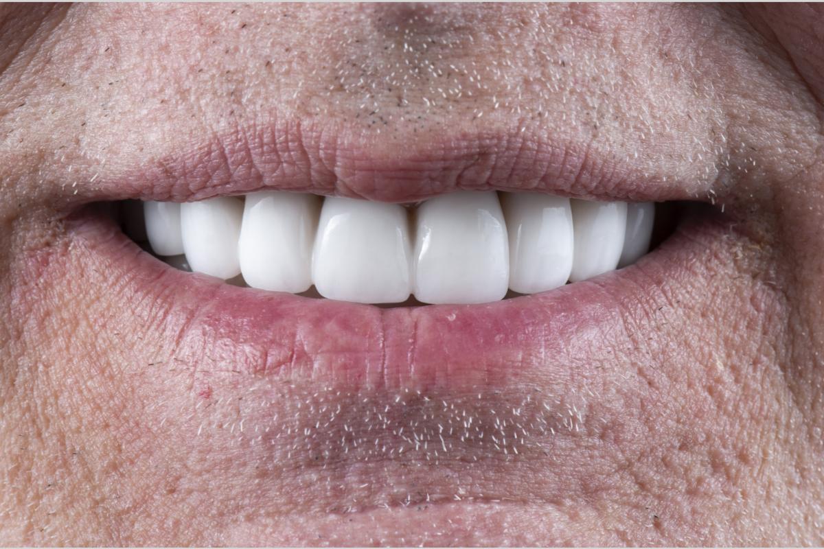 Benefits Of Dental Veneers Cosmetic Services In Tx